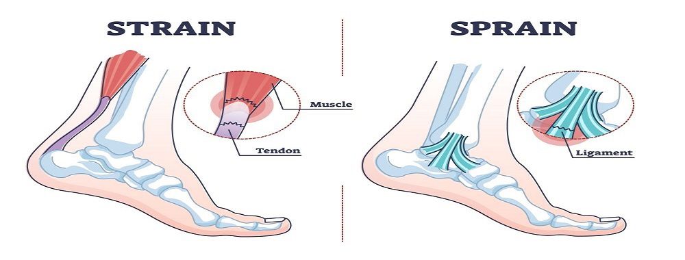 Repetitive Strains and Sprains - Vcare Physio & Rehab